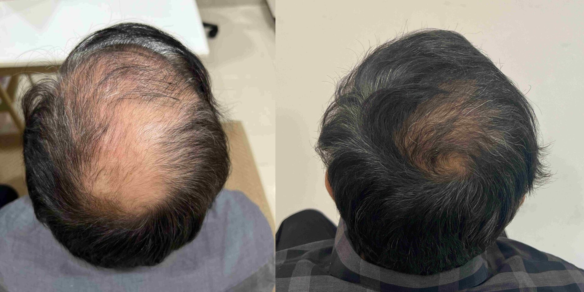 The Science Behind Hair Transplantation – Clinica Derm